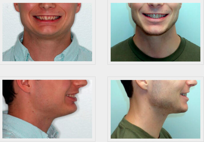 Truco para marcar la mandíbula rápido y de forma definitiva – Rísbel ...