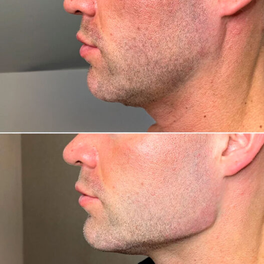 Truco para marcar la mandíbula rápido y de forma definitiva – Rísbel ...